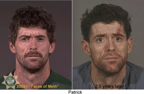 Top 33 des ravages terrifiants de la Meth en portraits avant / après